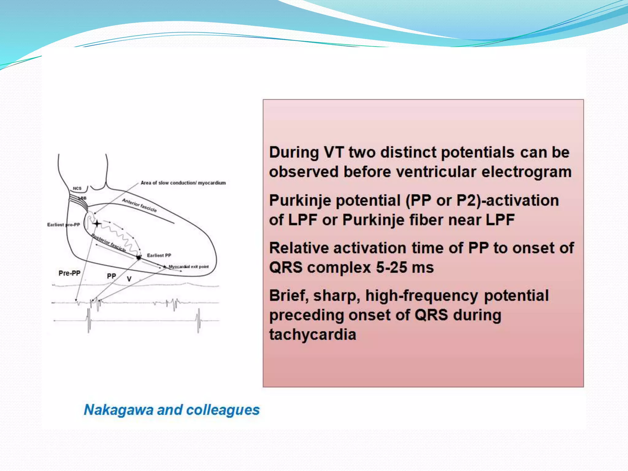 FASCICULAR VENTRICULAR TACHYCARDIA( VT) | PPTX