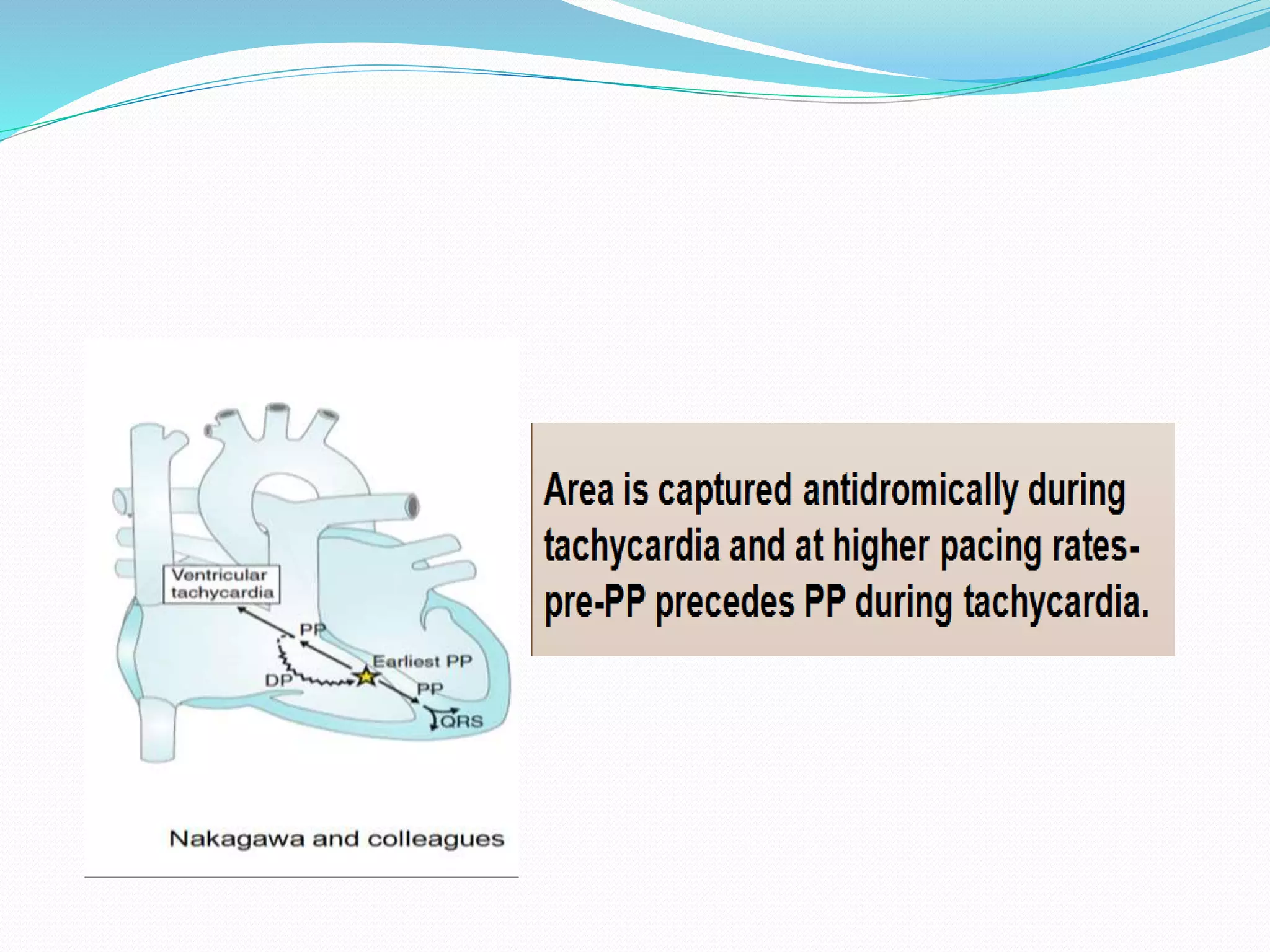 FASCICULAR VENTRICULAR TACHYCARDIA( VT) | PPTX