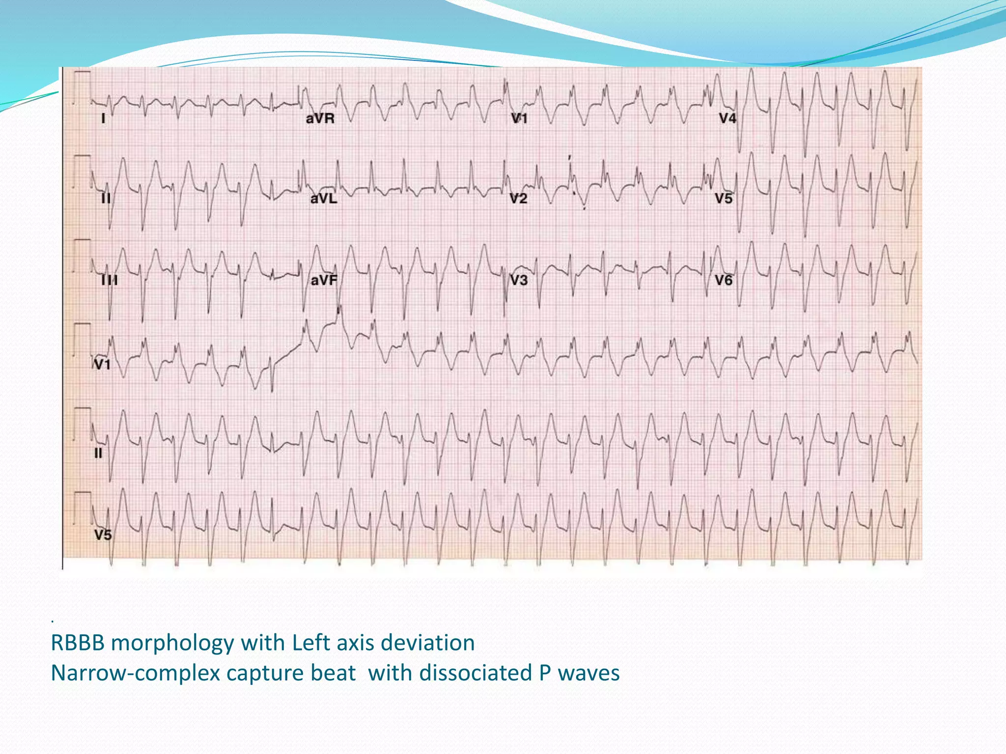 FASCICULAR VENTRICULAR TACHYCARDIA( VT) | PPTX | Heart and ...