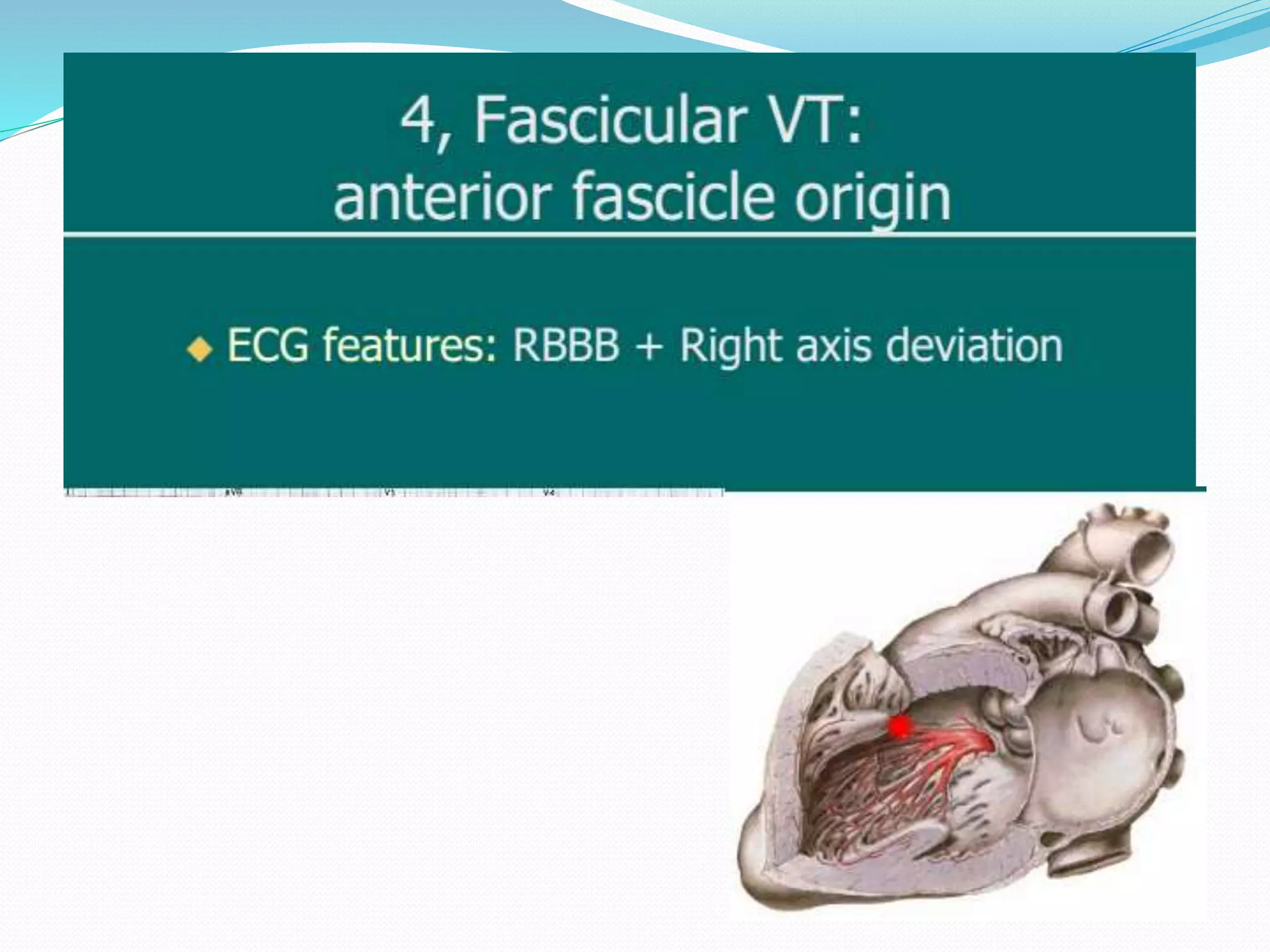 FASCICULAR VENTRICULAR TACHYCARDIA( VT) | PPTX