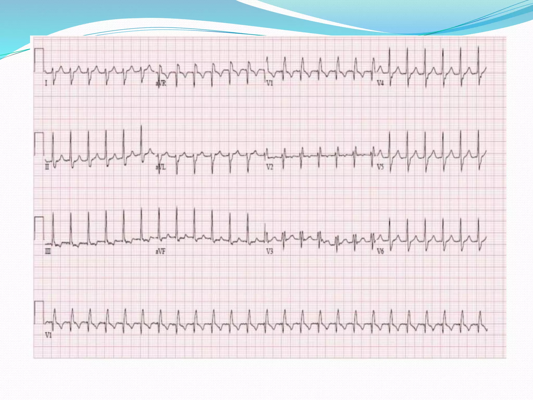 FASCICULAR VENTRICULAR TACHYCARDIA( VT) | PPTX | Heart and ...