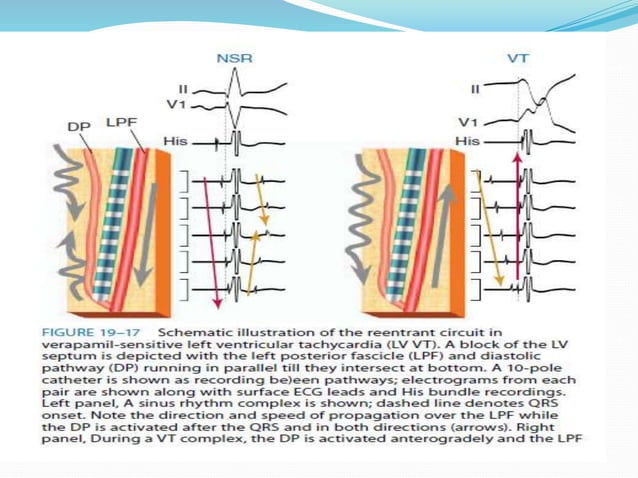 FASCICULAR VENTRICULAR TACHYCARDIA( VT) | PPT