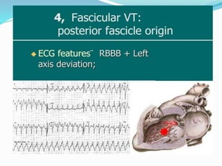 FASCICULAR VENTRICULAR TACHYCARDIA( VT) | PPT