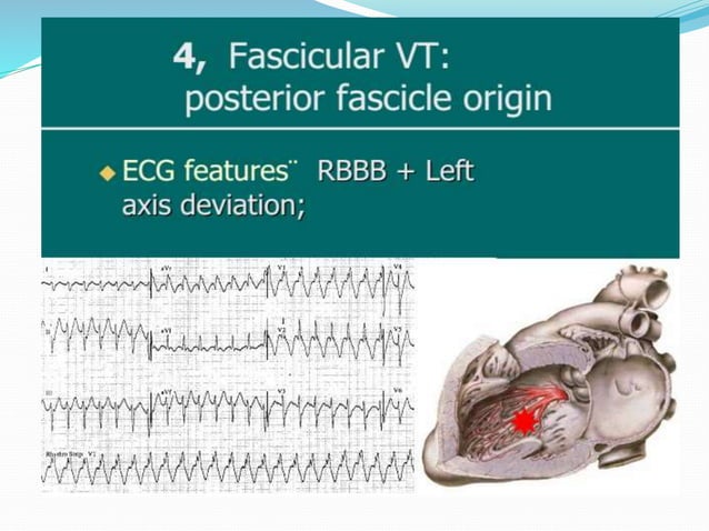 FASCICULAR VENTRICULAR TACHYCARDIA( VT) | PPT