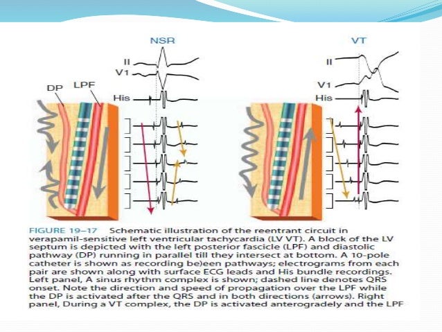 FASCICULAR VENTRICULAR TACHYCARDIA( VT)