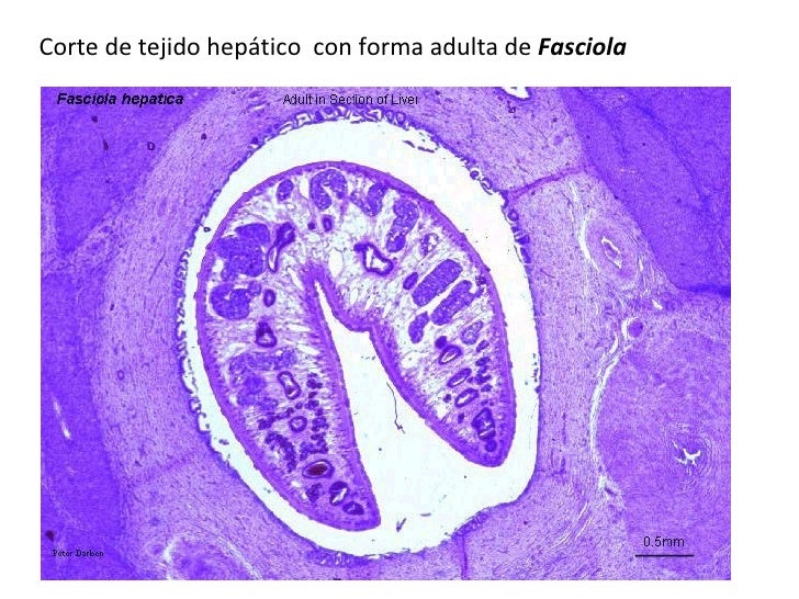 Fasciolosis Humana