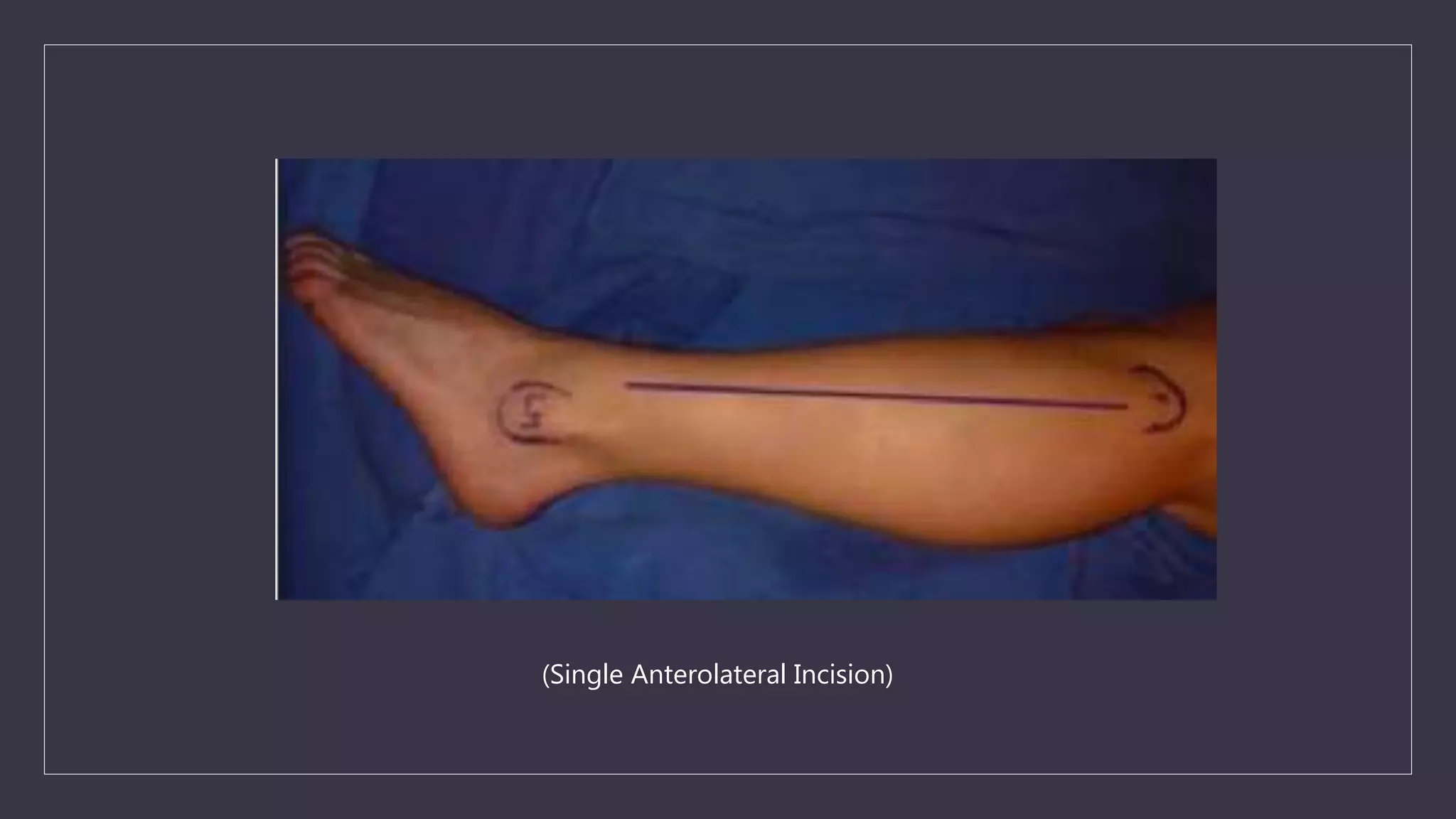 Fasciotomy & Escharotomy | PPTX
