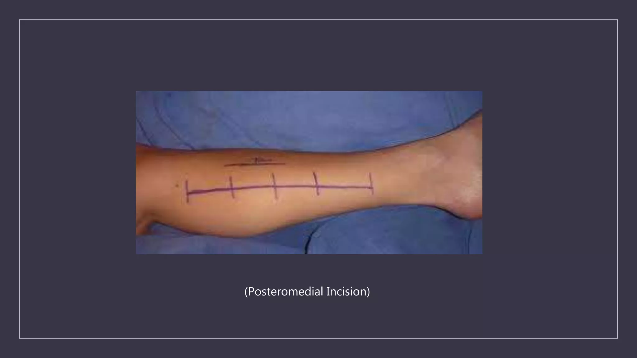 Fasciotomy & Escharotomy | PPTX