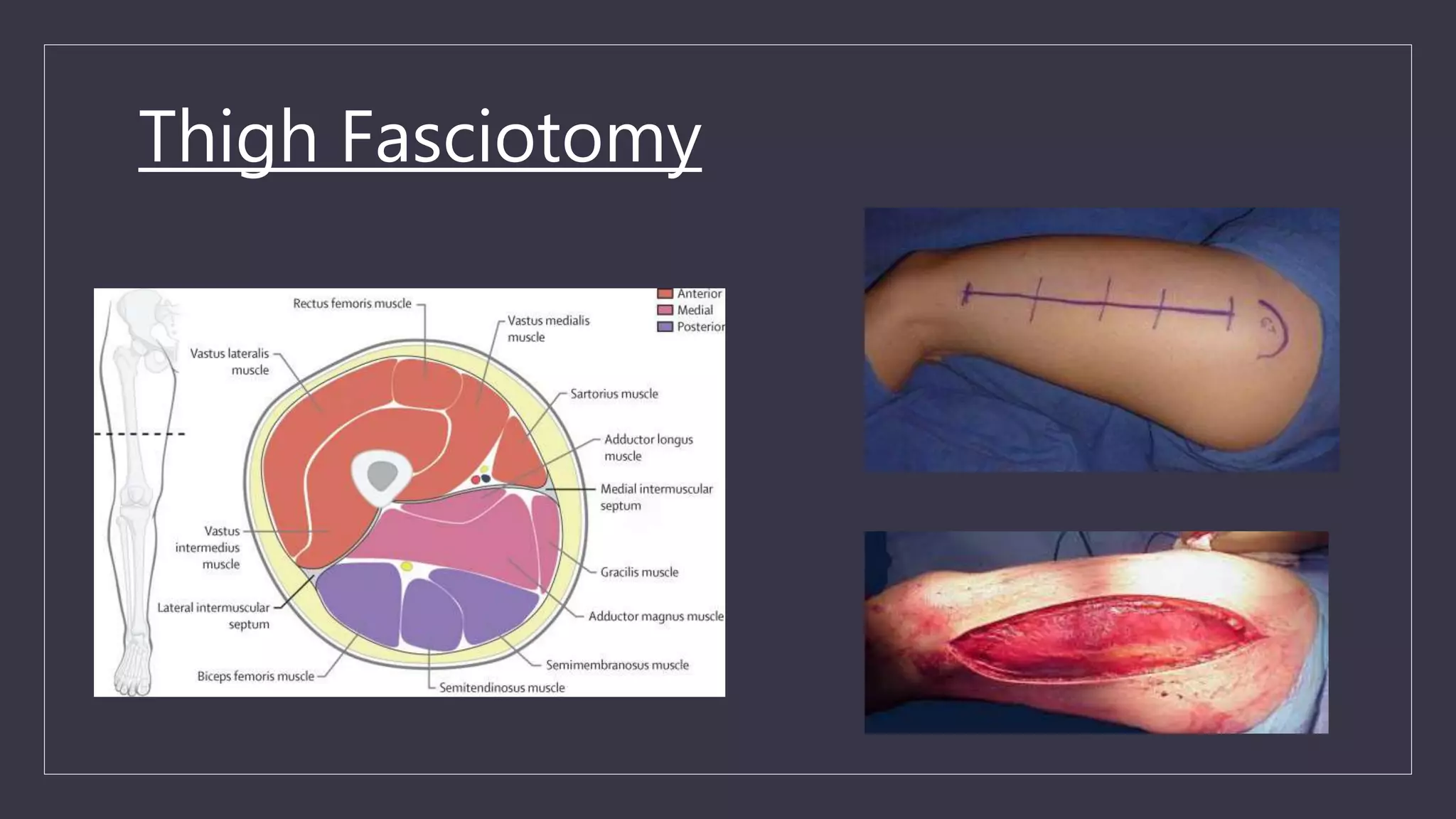 Fasciotomy & Escharotomy | PPTX