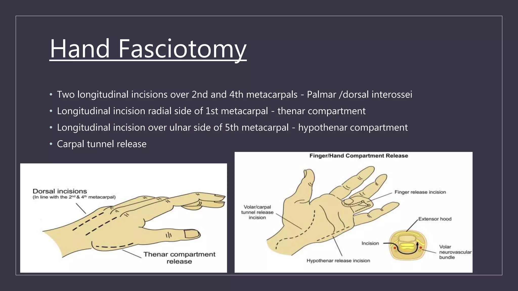 Fasciotomy & Escharotomy | PPTX