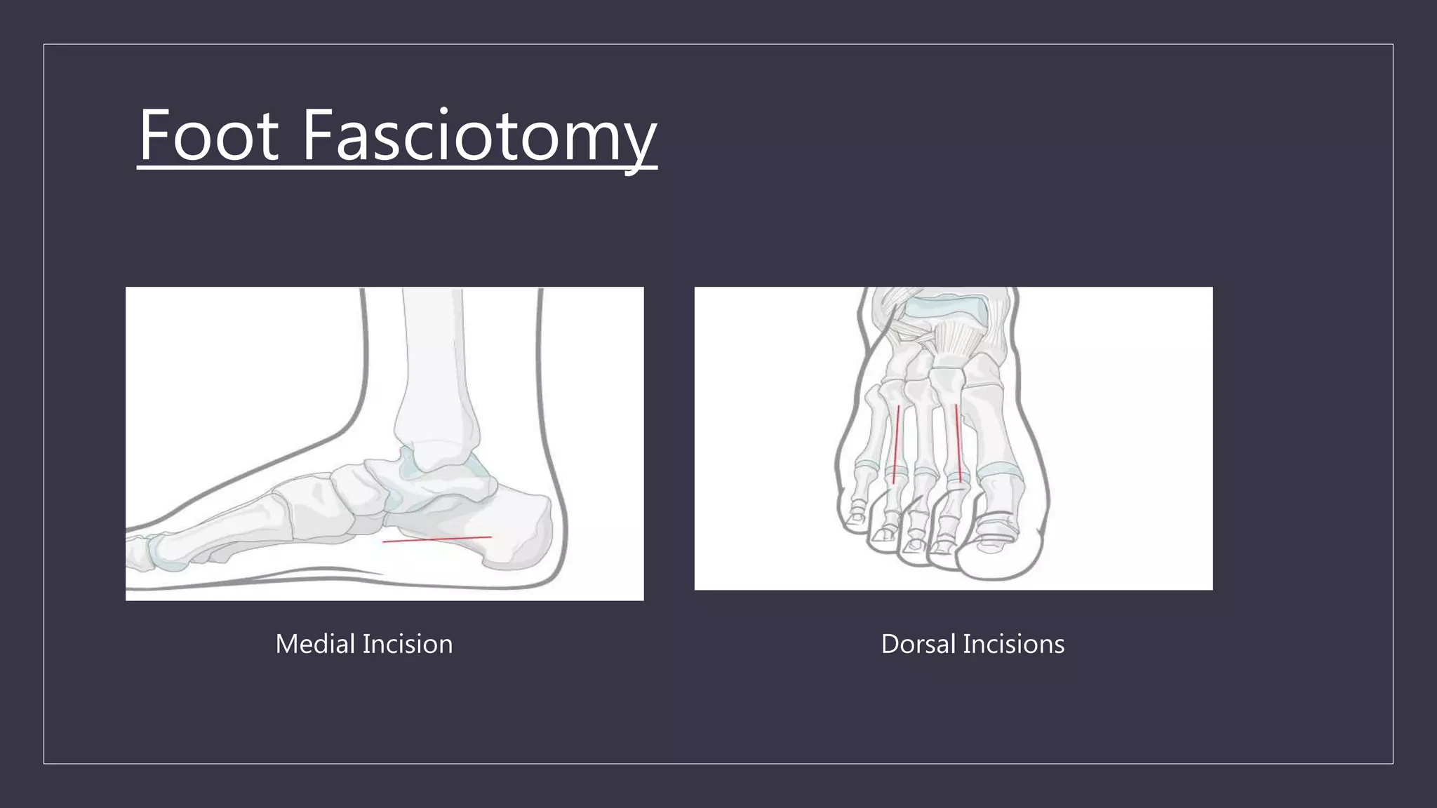 Fasciotomy & Escharotomy | PPTX
