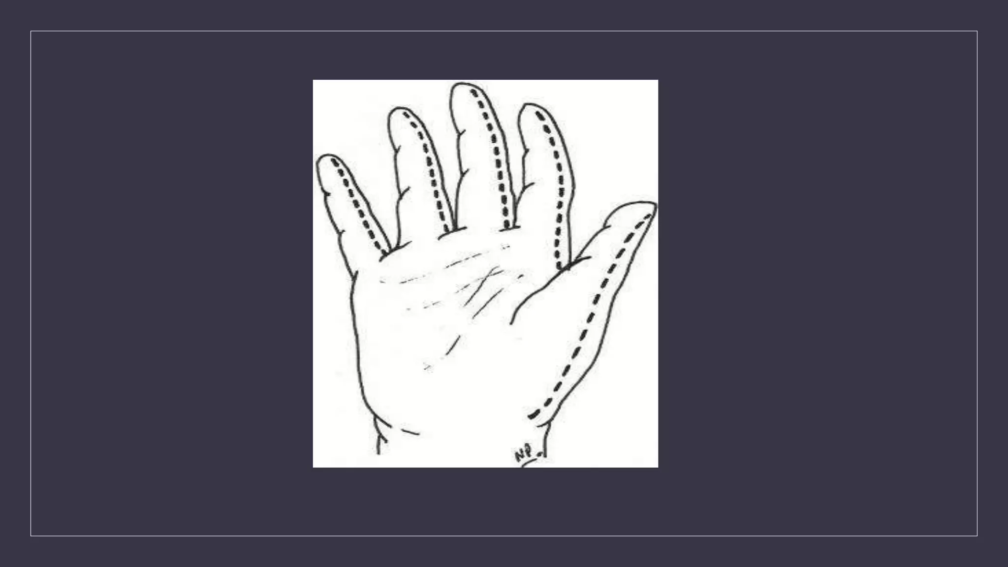 Fasciotomy & Escharotomy | PPTX