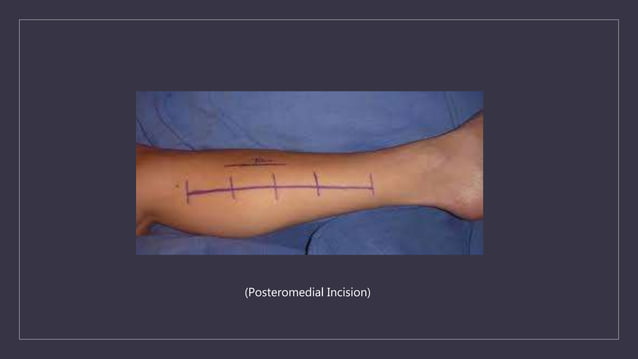 Fasciotomy & Escharotomy | PPTX