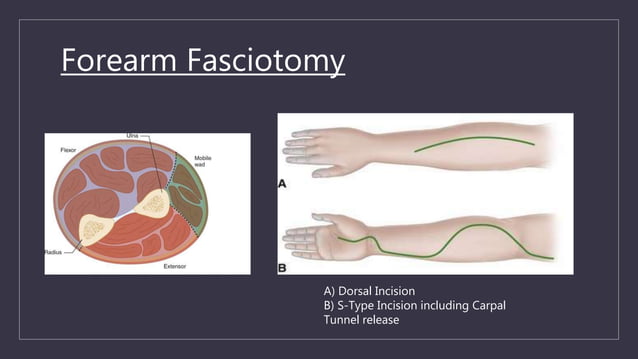 Fasciotomy & Escharotomy | PPTX