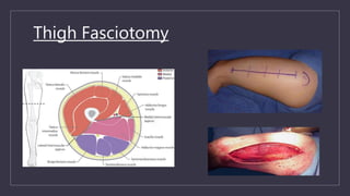 Fasciotomy & Escharotomy | PPTX