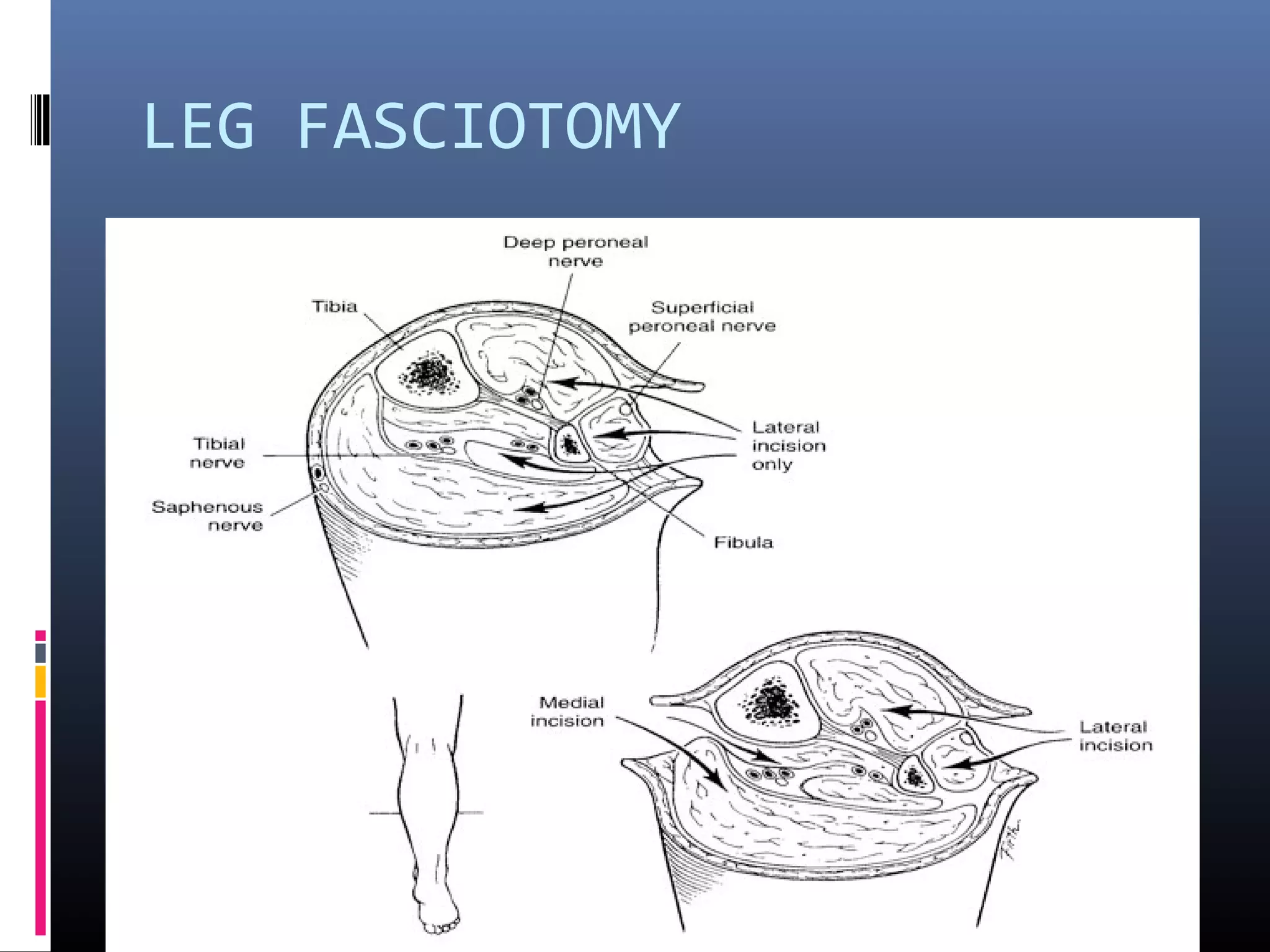 Fasciotomy | PPT