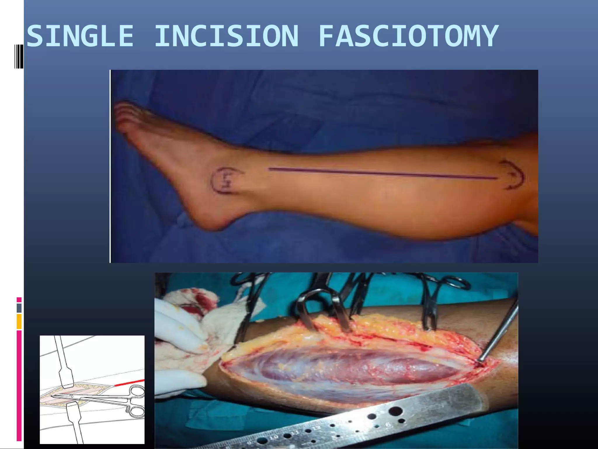 Fasciotomy | PPT