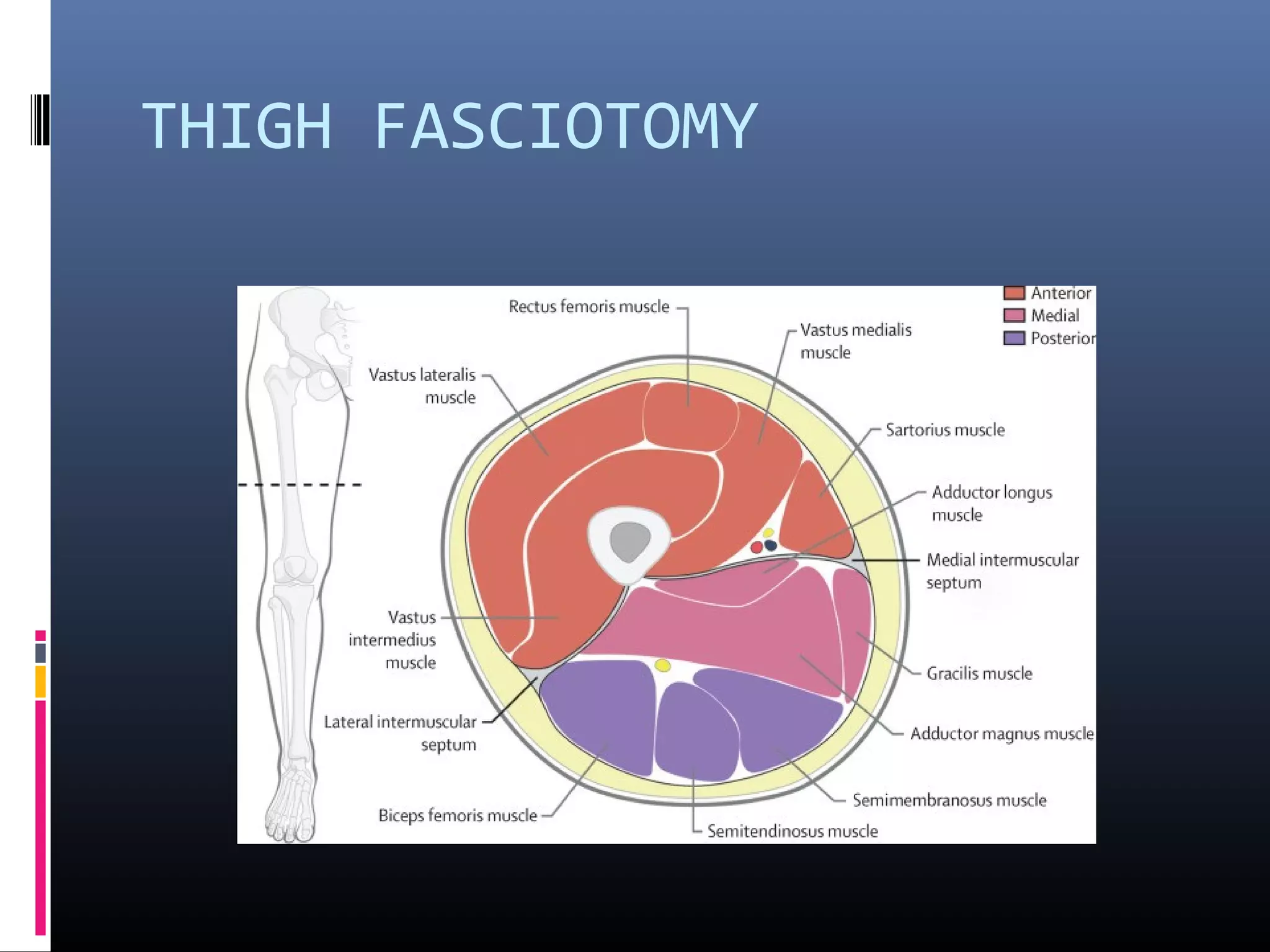 Fasciotomy | PPT