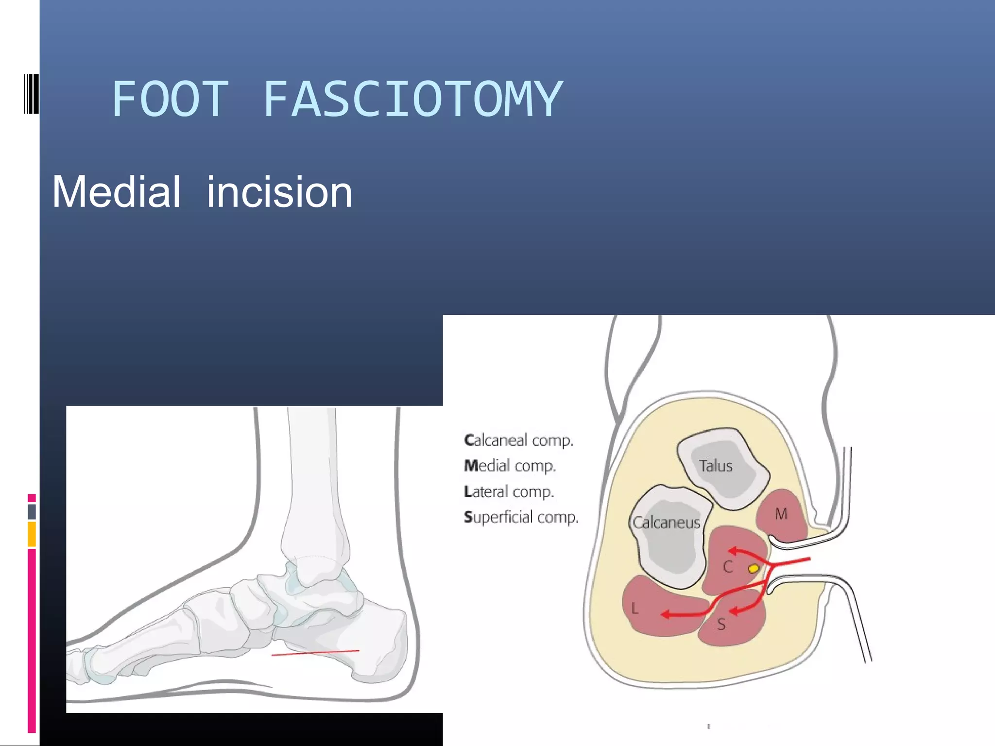 Fasciotomy | PPT