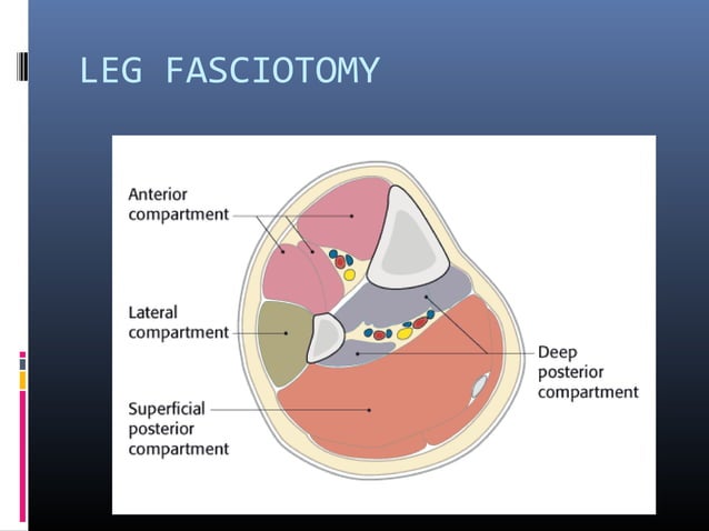 Fasciotomy | PPT