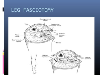Fasciotomy | PPT