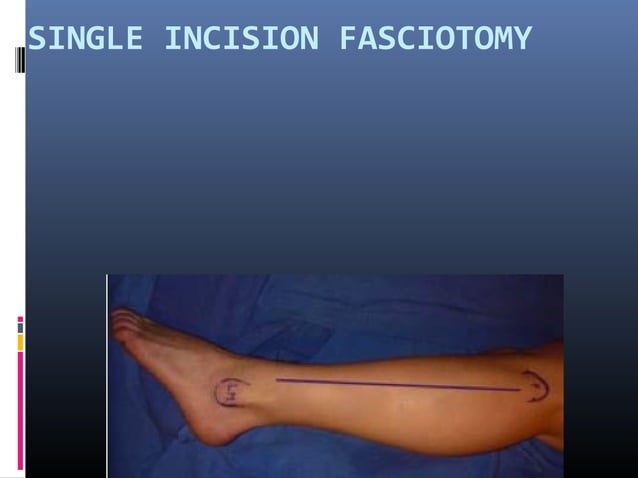 Fasciotomy | PPT