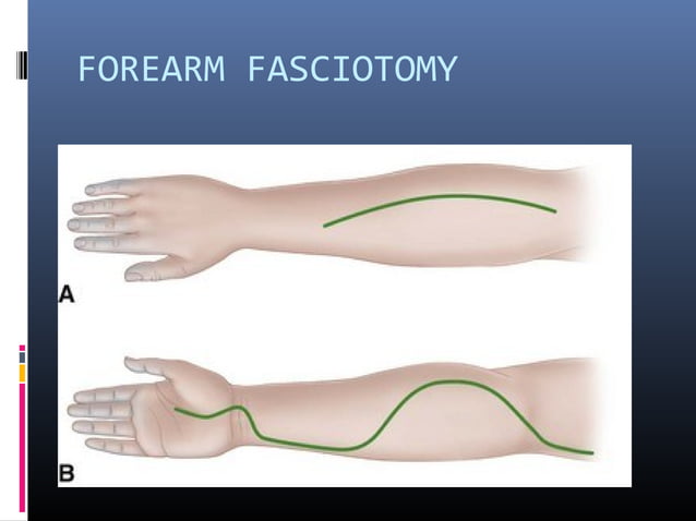 Fasciotomy | PPT