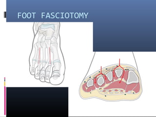 Fasciotomy | PPT