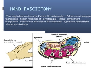 Fasciotomy | PPT