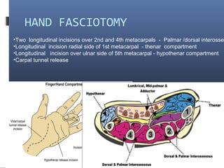 Fasciotomy | PPT