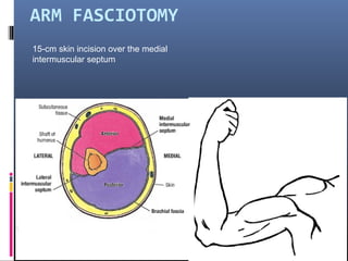 Fasciotomy | PPT