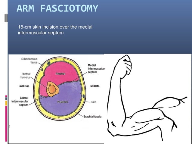 Fasciotomy | PPT