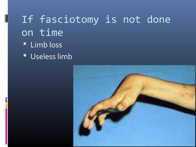 Fasciotomy | PPT