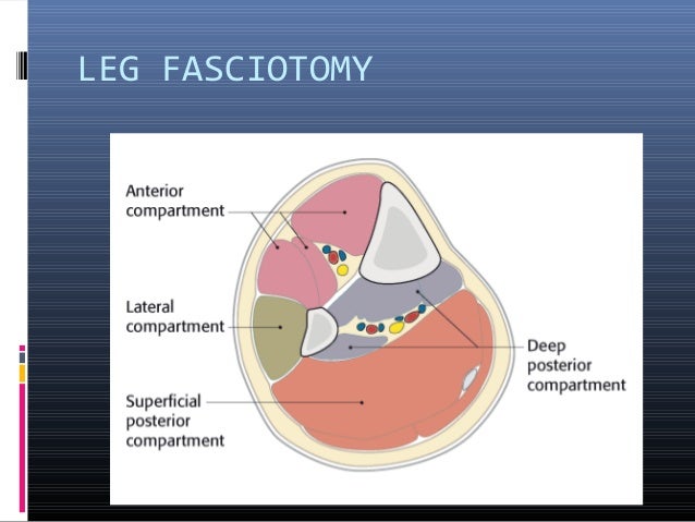 Fasciotomy