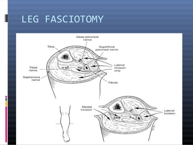 Fasciotomy