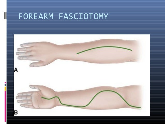 Fasciotomy