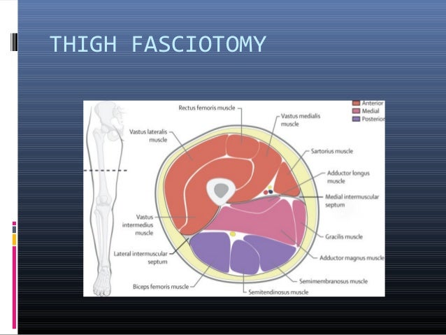 Fasciotomy