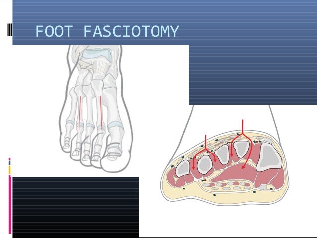 Fasciotomy