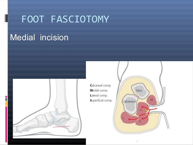 Fasciotomy