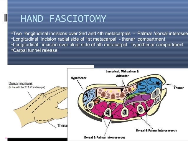 Fasciotomy