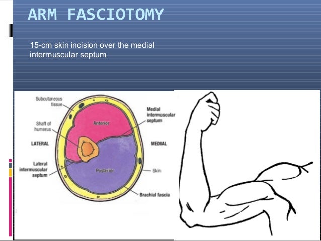 Fasciotomy