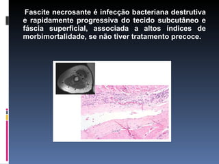 Fascite Necrosante Bacterias Comedoras De Carne | PPT