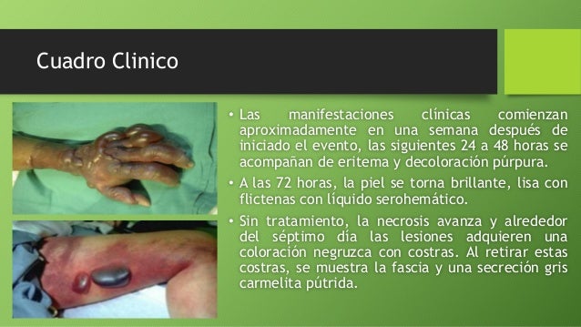 Fascitis Necrotizante