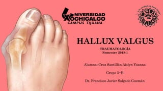 Fascitis plantar y hallux valgus | PDF