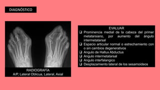 Fascitis plantar y hallux valgus | PDF