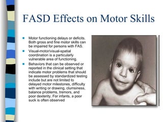 Fetal Alcohol Spectrum Disorder | PPT