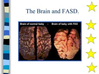 Fetal Alcohol Spectrum Disorder | PPT