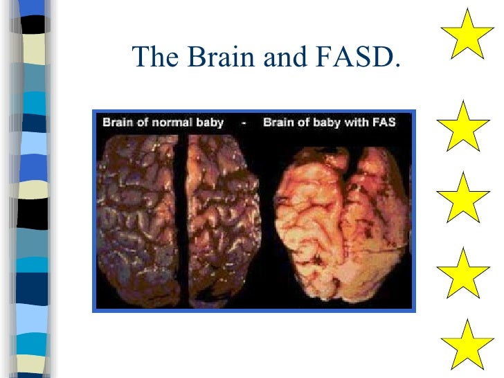 Fetal Alcohol Spectrum Disorder