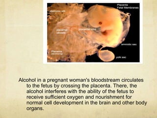 Fetal alcohol syndrome | PPTX