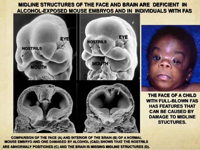 Fetal alcohol syndrome